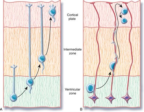 Neuronal Migration Clinical Tree