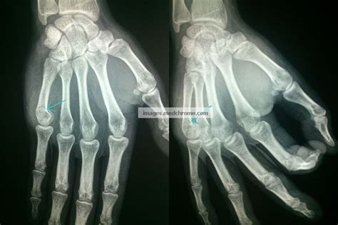 Boxers Fracture Fracture Of Neck Of 5th Metacarpal Medchrome Images