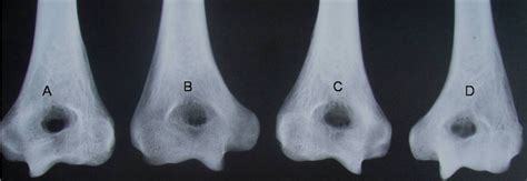X Ray Of Humerus Showing A Supratrochlear Foramen B 2 Minute Opening Download Scientific