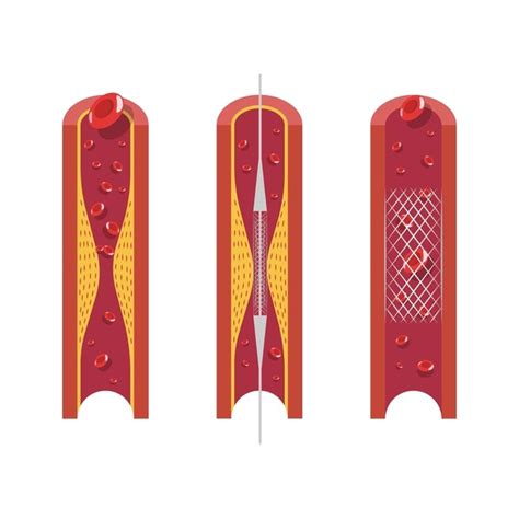 7 Cardiac Catheter Bleeding Stock Vectors And Vector Art Shutterstock