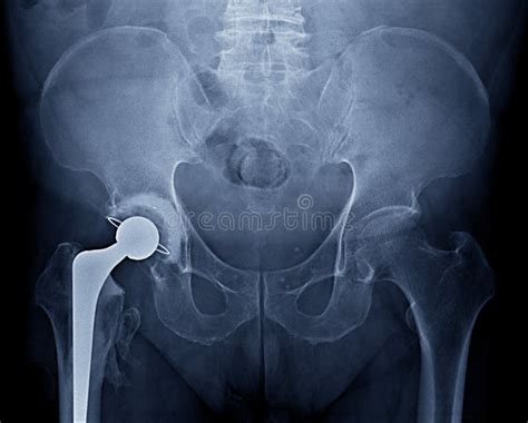 Pelvic X Ray Stock Photography Image 24527862