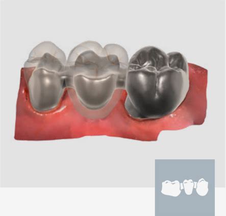 Exocad Shining Ddental Com