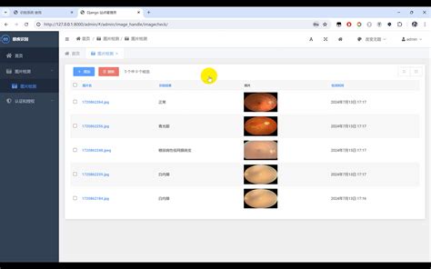 【眼疾识别】python深度学习人工智能算法模型训练tensorflowcnn卷积神经网络算法眼疾智能识别系统 Csdn博客