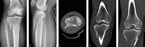 Tibia And Fibula Proximal Metaphyseal Simple Fracture—41 A2 Musculoskeletal Key