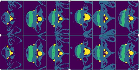 Unet3d Bagging Ct Spine Segmentation Data 3dp Py At Master · Huatsing