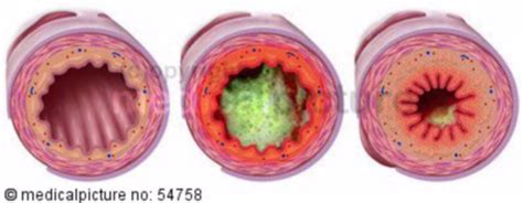 Bronchus Cross Section