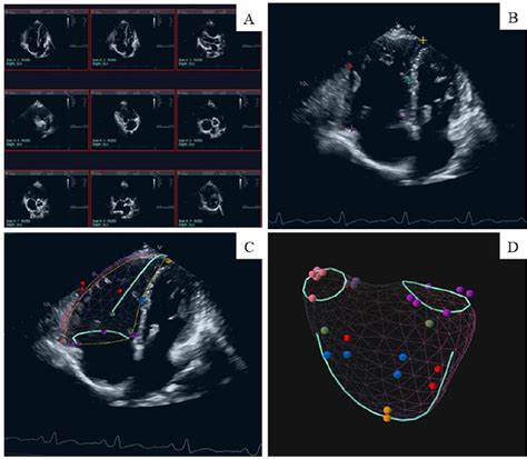 Figure 1 From Assessment Of Right Ventricular Arterial Coupling By