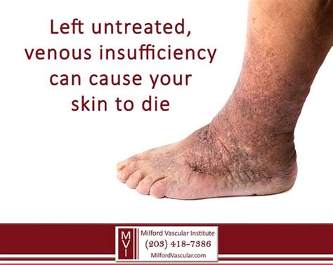 Venous Insufficiency Can Be Debilitating And Deadly If Untreated