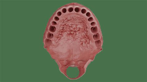 3d Model Of Candidal Stomatitis Voka