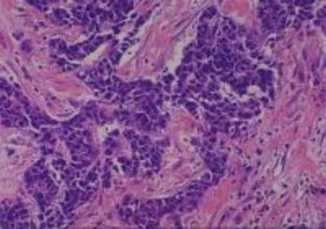 Novus Biologicals™ Human Breast Tissue Microarray Cancer Human Breast Cancer Metastasis Tissue