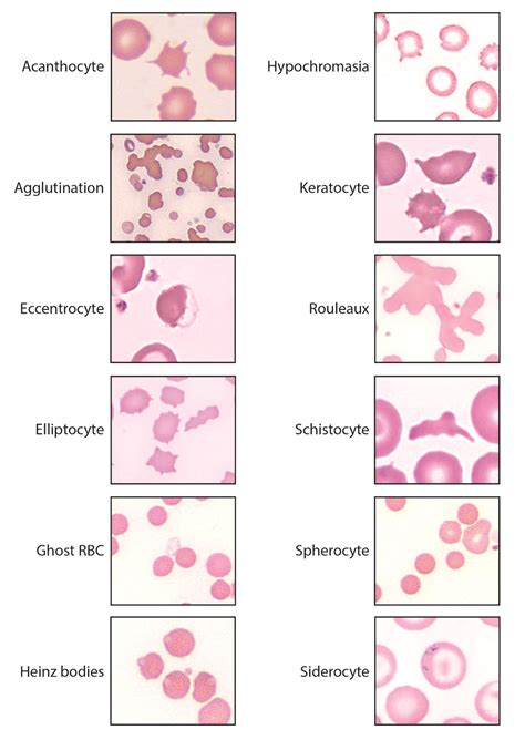Abnormalities Of Rbc Shape Clinical Pathology And Hemolymphatics