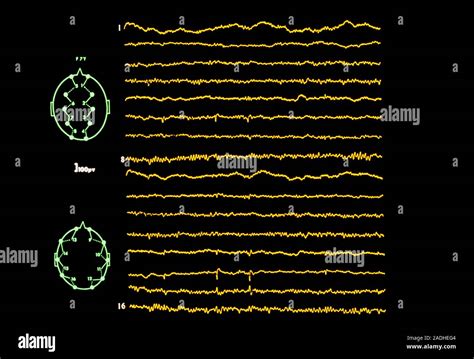 Focal Epilepsy Electroencephalogram Eeg Showing Focal Epileptic