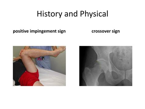 Ppt Hip Arthroscopy Powerpoint Presentation Free Download Id 2121609