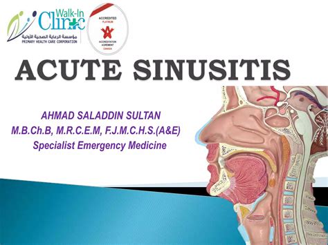 Sinusitis Acute Versus Chronic Ppt