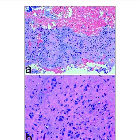 Complex Subtype Of Endometrial Tubal Metaplasia With Cribriform Glands