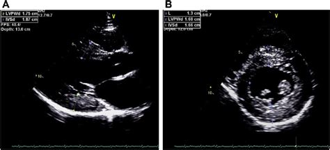 Baseline Transthoracic Echocardiogram Demonstrating Concentric Lv