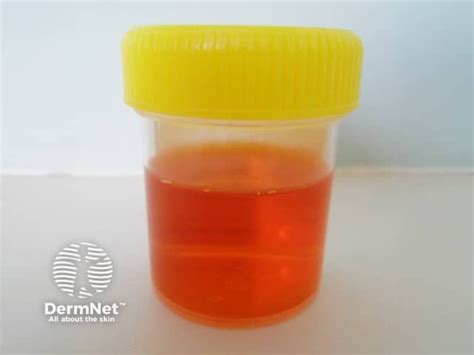 Discoloured Urine On Rifampicin Image