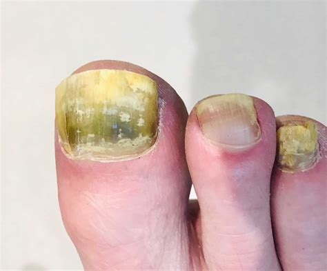 Fungal Nail 6 Top Questions Answered A Step Ahead Foot And Ankle Care