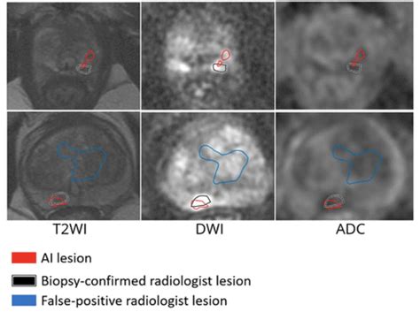 Aua 2023 Detection Of Clinically Significant Prostate Cancer On Mri A Comparison Of An