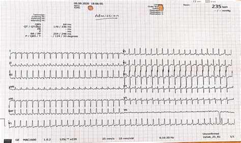 Postnatal Ecg Precardioversion Showing The Neonate Still In Atrial Download Scientific Diagram