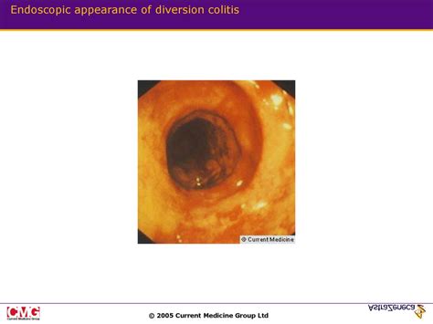 Enfermedad Inflamatoria Intestinal Ppt Descargar