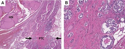 Figure 1 From Performance Of A Multigene Genomic Classifier In Thyroid Nodules With Suspicious