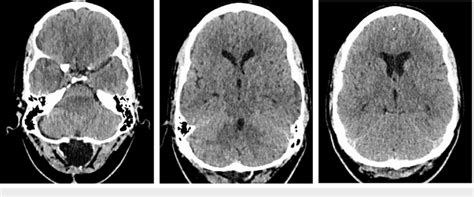 Ct Head After Posterior Fossa Re Exploration Surgery Download Scientific Diagram