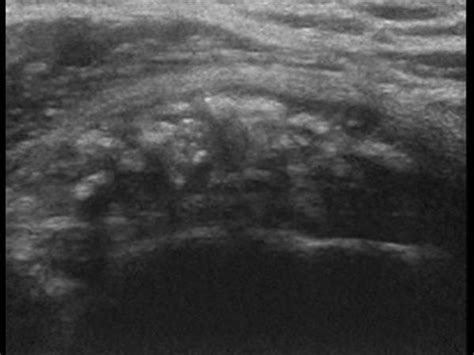 Musculoskeletal Joints And Tendons 61 Shoulder Case 6118 Bursa