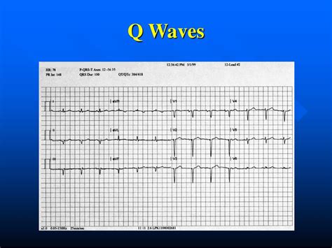 Ppt 12 Lead Ekg 101 Powerpoint Presentation Free Download Id3223309