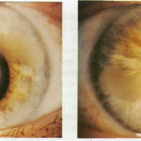 Diagram Showing Contrast Sensitivity Vistech Chart At The Spatial Download Scientific
