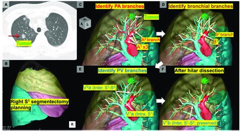 Sequential 3d Images Simulating Right Apical S 1 Segmentectomy A Download Scientific