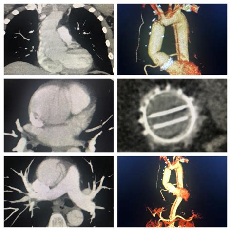 Aortic Root Replacement With Composite Valve Graft With Reimplantation