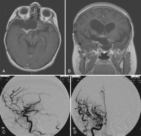 Optic Pathway Hypothalamic Gliomas Neupsy Key
