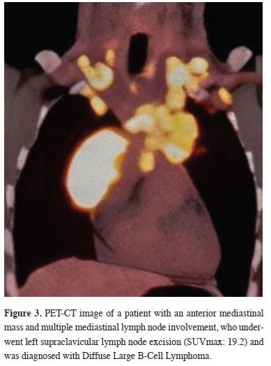 Clinical And Diagnostic Significance Of Supraclavicular Lymph Node