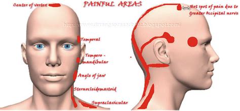 Trigeminal Neuralgia Trigger Points
