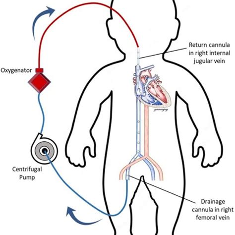 Veno Venous Vv Ecmo Blood Is Accessed Via The Femoral Vein Passed