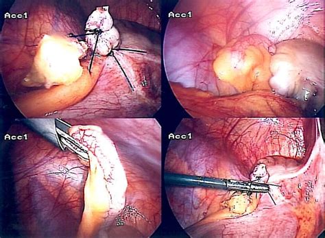Acute Appendicitis Clinical Features Management Teachmesurgery