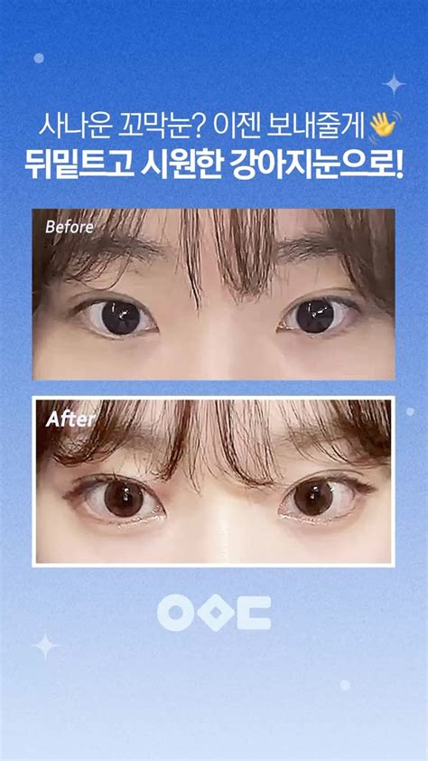 아몬드성형외과 이인호 원장님 이마거상 Open 여러 눈성형 고민 쌍수만으로 해결되지 않을 때 이마거상과 함께한다면 해결 가능🩶 모두 아몬드성형외과를 찾아주세요😊