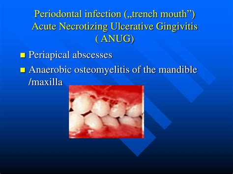 Necrotizing Ulcerative Gingivitis Treatment Gum Disease Gingivitis