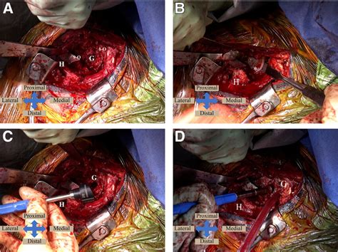 Intraoperative Pictures Of Glenoid Component Preparation In Right