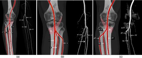 Figure 1 From Popliteal Artery Branching Variations On Computed