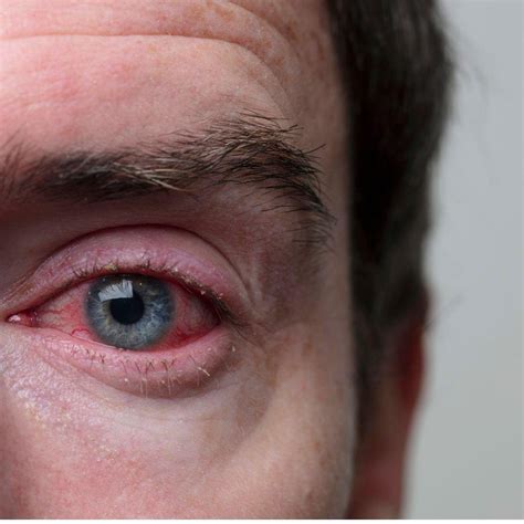 Conjunctivitis Understanding The Pink Eye Infection Ashob E Chashm