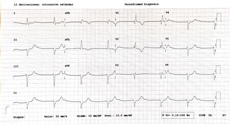 Curso Ecg Fibrilación Auricular Con Bloqueo Av Completo