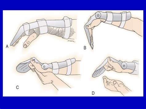 Hand Exercises After Flexor Tendon Repair At Roy Bush Blog