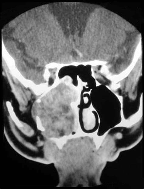 Temporalis Muscle Transposition Clinical Tree