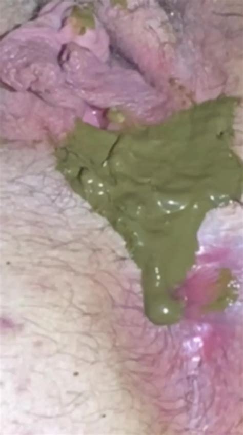 Worms Anal Maggots 1