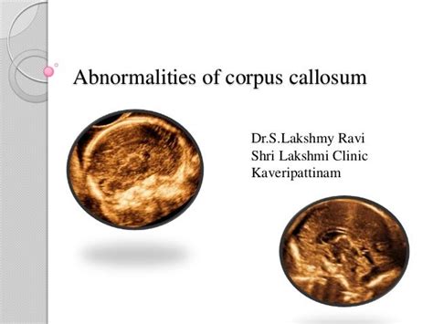 Abnormalities Of Corpus Callosum