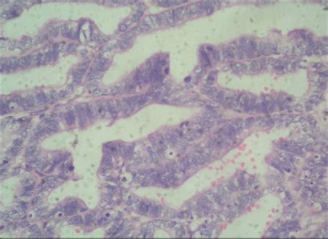 Choroid Plexus Carcinoma In An Adult Journal Of Neurosciences In Rural Practice