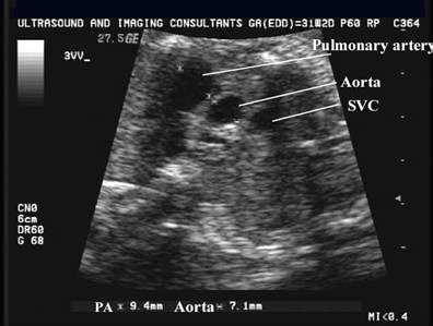 Coarctation Of The Aorta