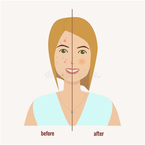 Woman`s Face With Skin Problems Before And After Skin Treatment Stock
